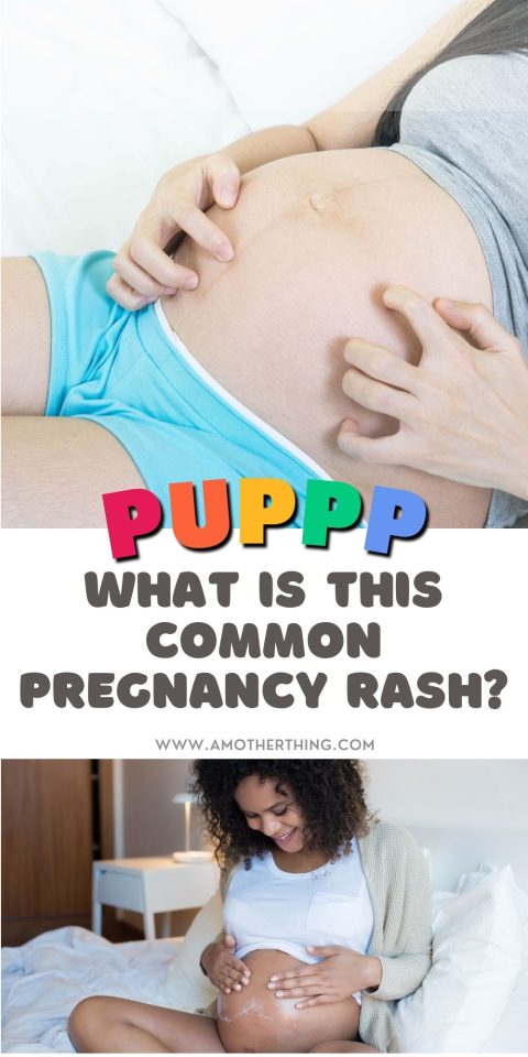 PUPPP Rash: Definition, Symptoms, Causes, & Treatment